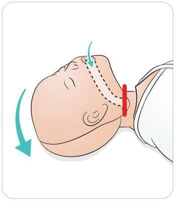 Open airway angles for Resusci Baby QCPR
